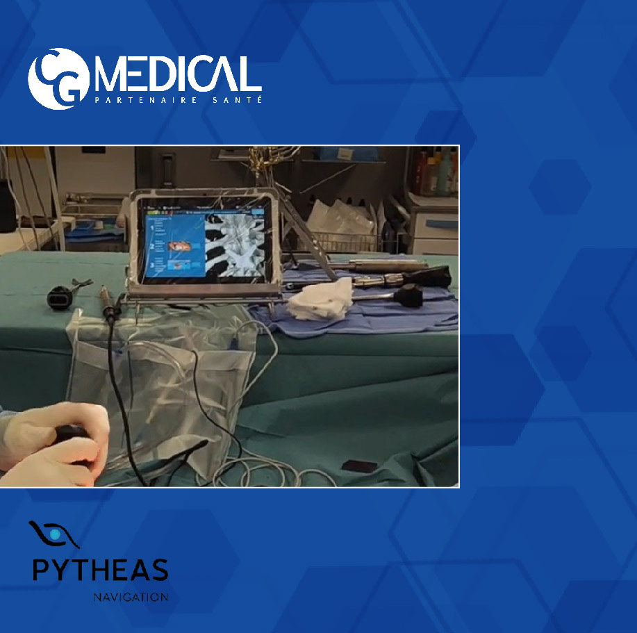 Découvrez la Collaboration entre CG MEDICAL et PYTHEAS Navigation ...